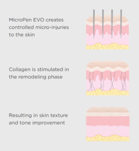 Microneedling - Aspire Skin Health