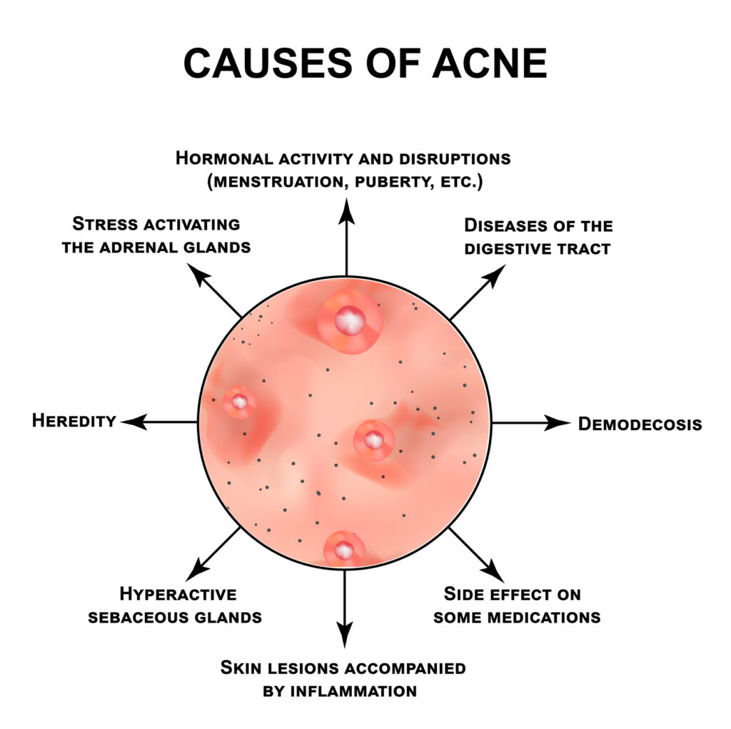Acne - Aspire Skin Health