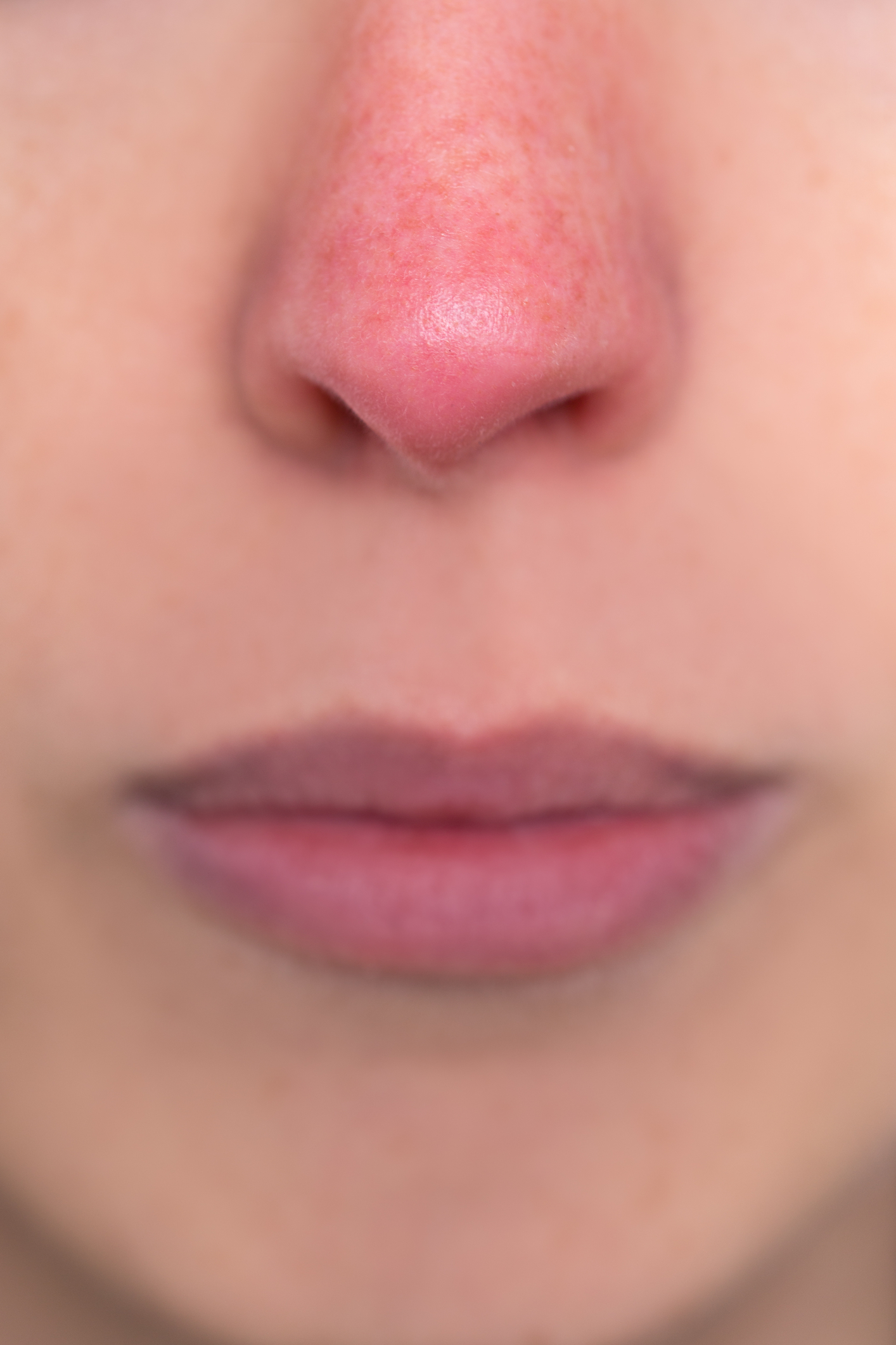 Rosacea - Aspire Skin Health