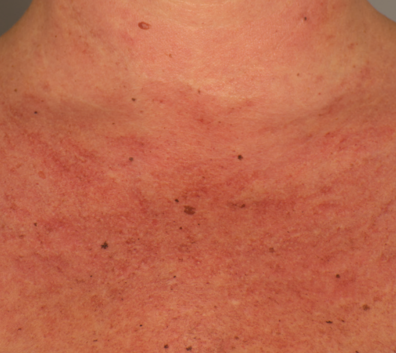 ClearSilk Laser - Aspire Skin Health