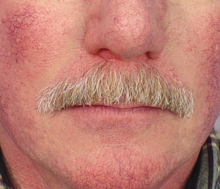 ClearV Laser - Aspire Skin Health