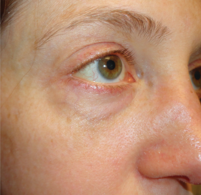 ClearV Laser - Aspire Skin Health